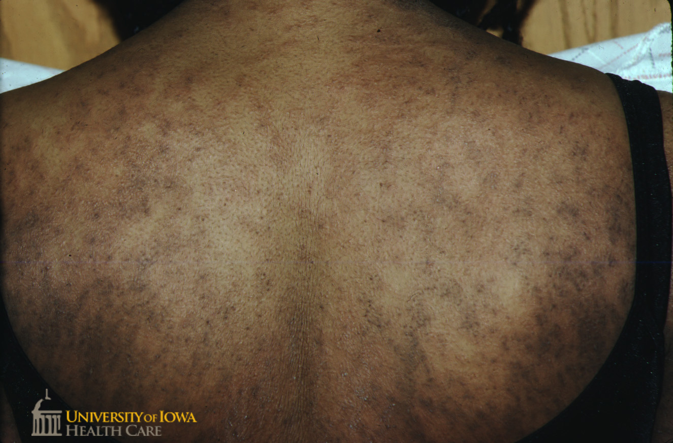 Erythematous targetoid papules with central hyperpigmentation on the back. (click images for ...